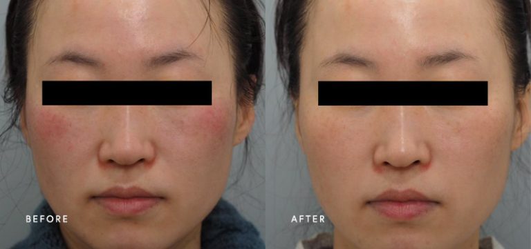 DermaV Laser Skin Rejuvenation - Devorah Shagalov, MD